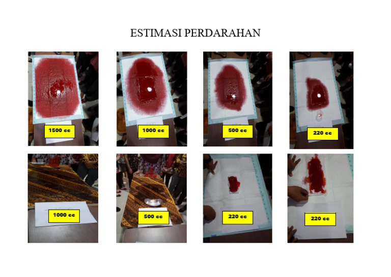 Estimasi Perdarahan Dipajang | PDF