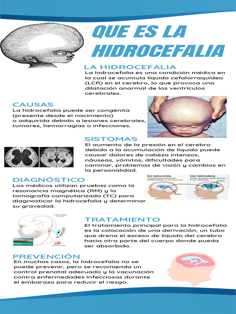 Infografía Hidrocefalia - 20231106 - 221937 - 0000 | PDF