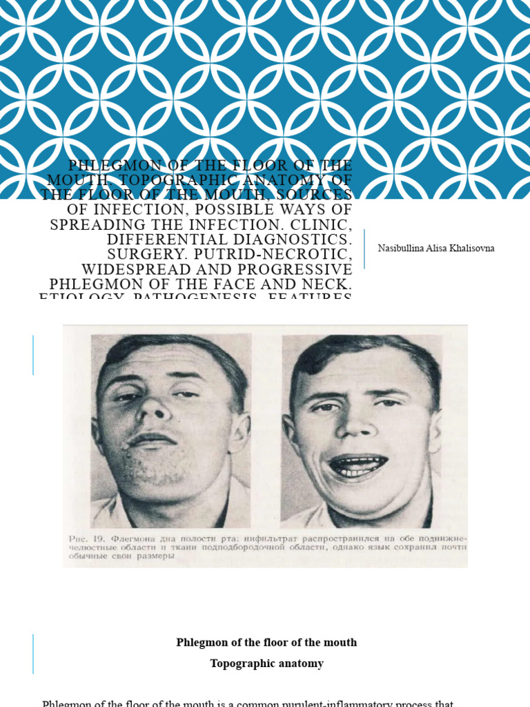 лекция 8 Phlegmon of the floor of the mouth. Topographic anatomy of the ...