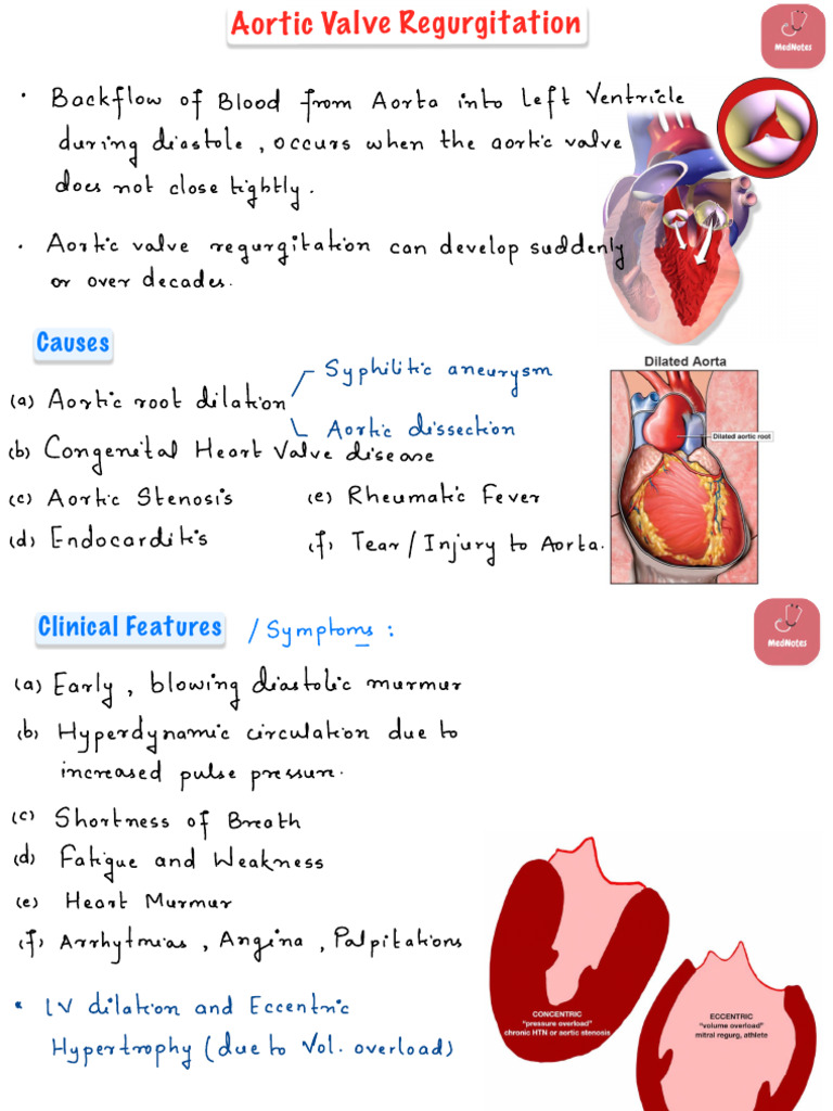 Aortic Regurgitation Overview and Causes | PDF