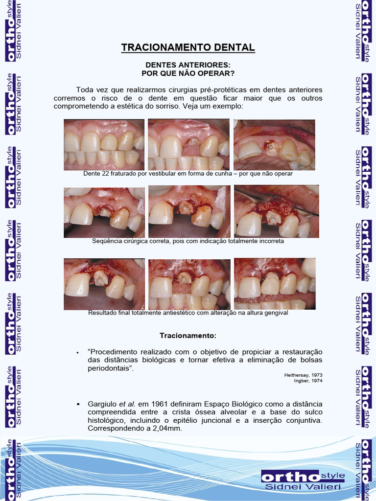 13-Procedimentos Peridontais Auxiliares Da Orto | PDF | Dente | Anatomia