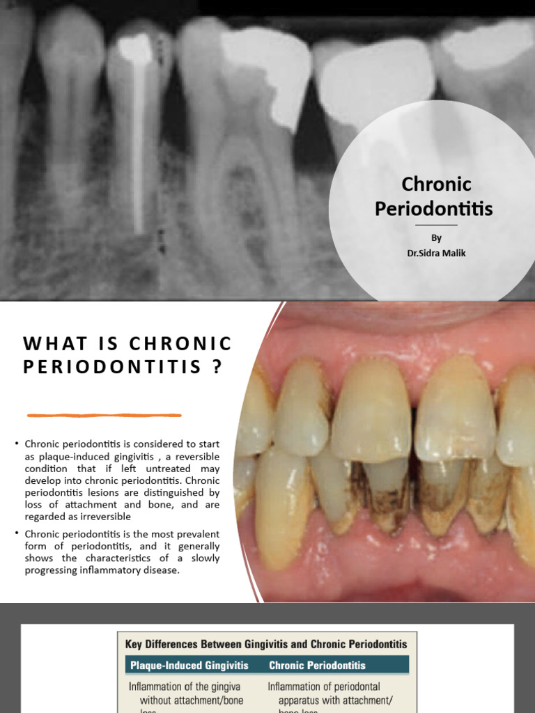 Understanding Chronic Periodontitis | PDF | Periodontology | Health Care