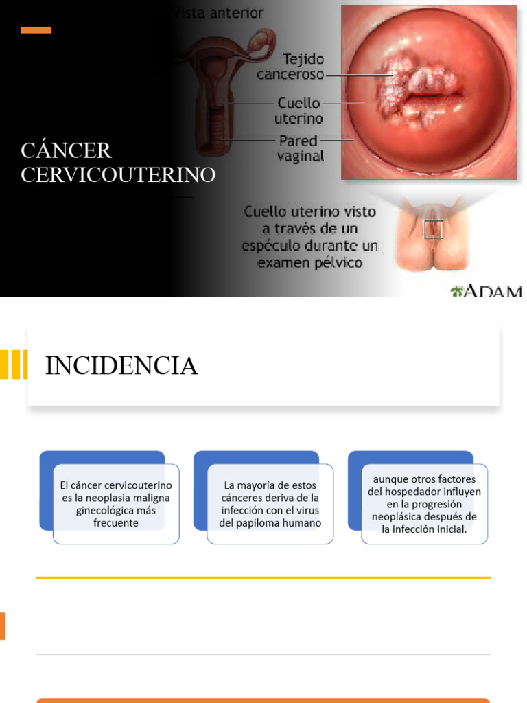 Cáncer Cervicouterino | Descargar gratis PDF | Cáncer de cuello uterino | Cáncer