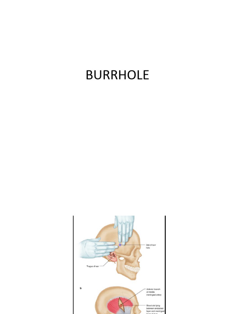 Burr Hole | PDF | Science & Mathematics