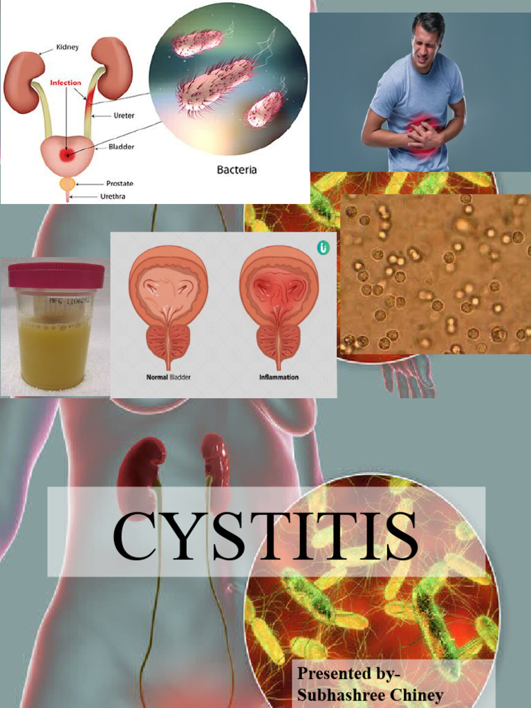 Cystitis | PDF | Urinary Tract Infection | Urinary System