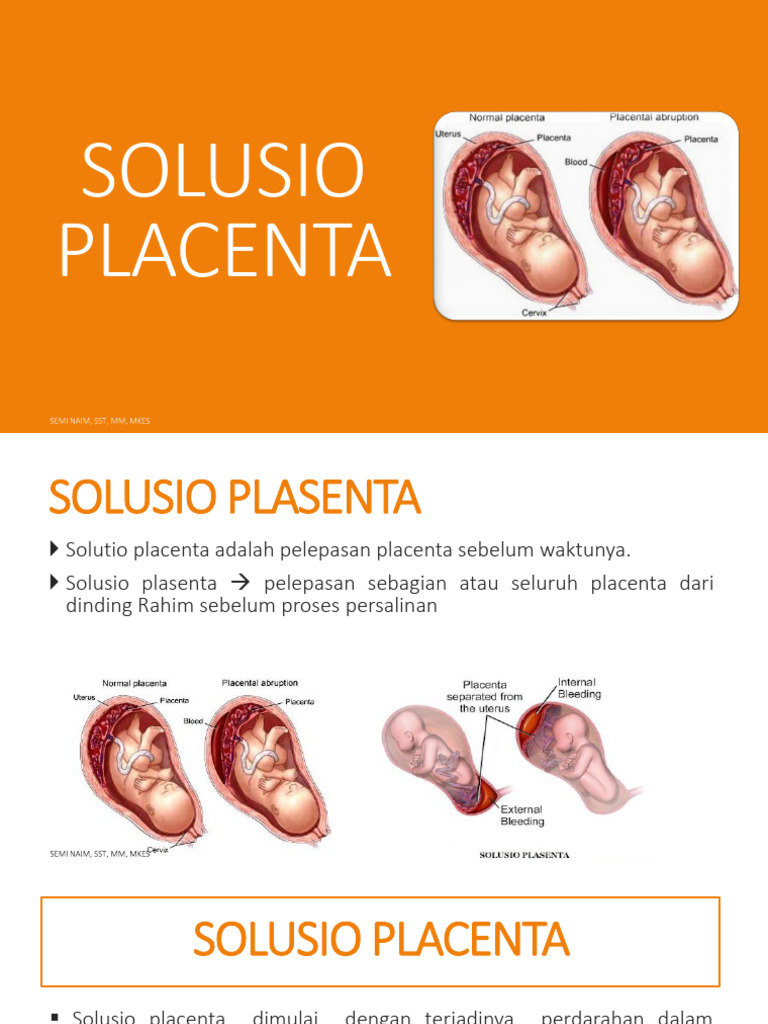 Solusio Placenta | PDF