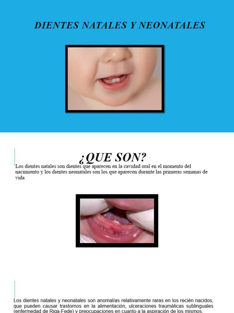 Dientes Natales y Neonatales | Descargar gratis PDF | Diente | Ciencias ...