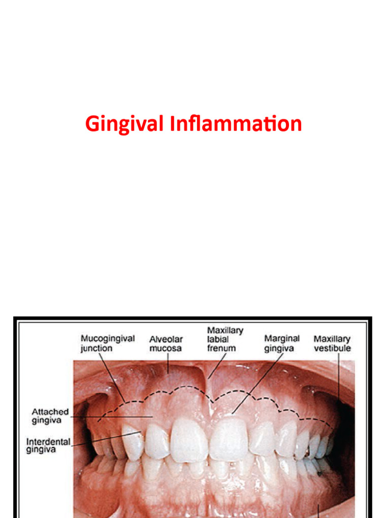 G9 Gingival Inflammation | PDF | Periodontology | Inflammation