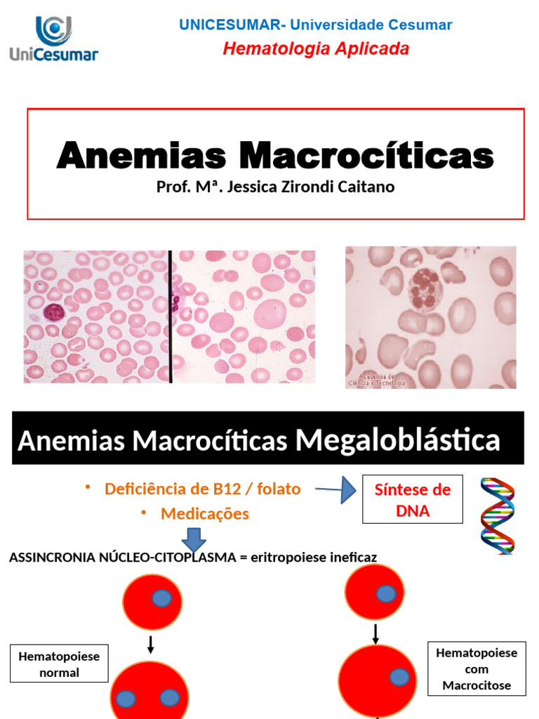 Aula 5 - Anemias Macrocíticas | PDF | Anemia | Vitamina B12