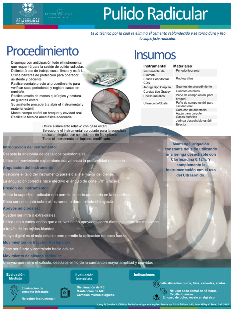 Pulido Radicular (Procedimiento, Insumos e Indicaciones) | PDF ...