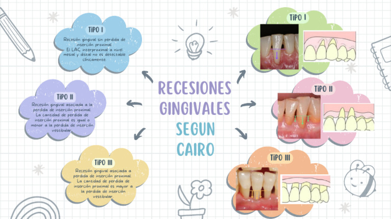 Recesiones gingivales segun Cairo | PDF