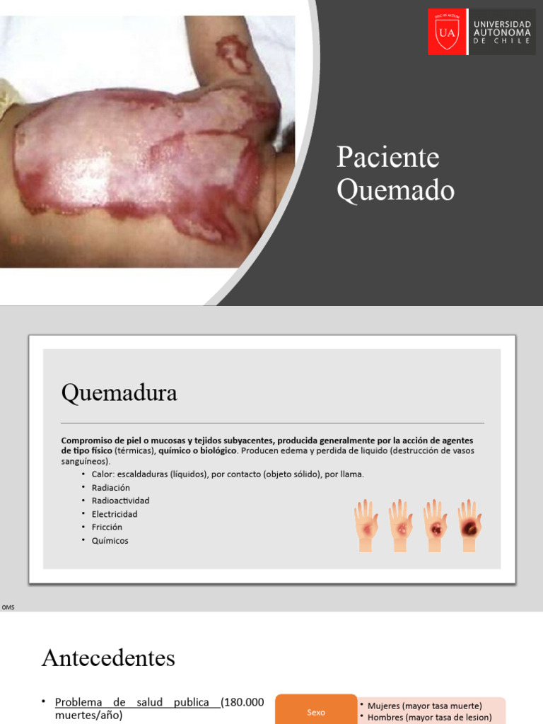 Manejo y tratamiento de quemaduras graves | PDF | Inflamación | Quemar