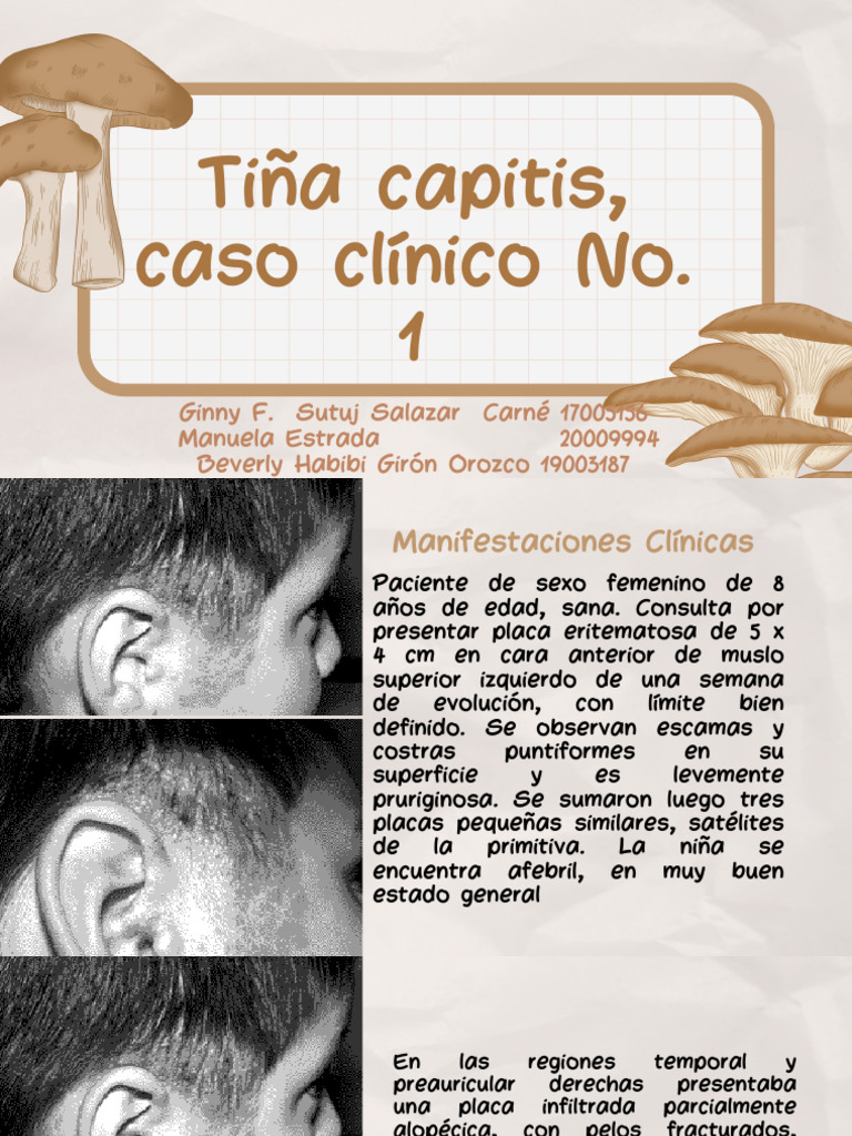 Tiña capitis: diagnóstico y tratamiento | PDF | Piel | Inmunología