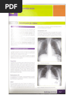 Radiografía de Tórax Normal - Patrón Intersticial | PDF | Pulmón | Tórax