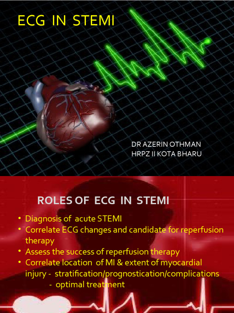 Ecg in Stemi DR Azerin | PDF | Electrocardiography | Myocardial Infarction