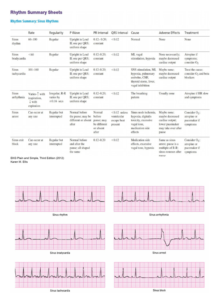 Rhythm Summary Review Packet EKG CLass | Download Free PDF ...