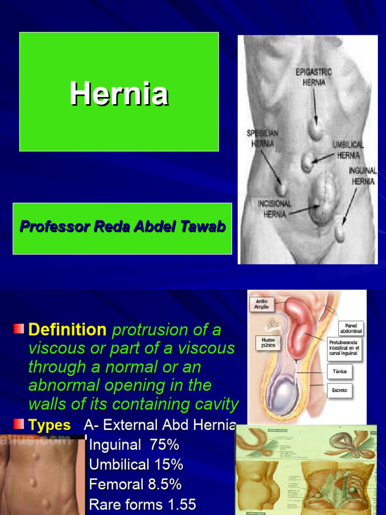 Comprehensive Guide to Hernias | PDF