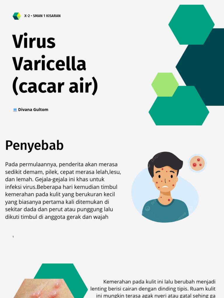 Penyakit Virus Cacar Air Divana X2 | PDF | Sains & Matematika