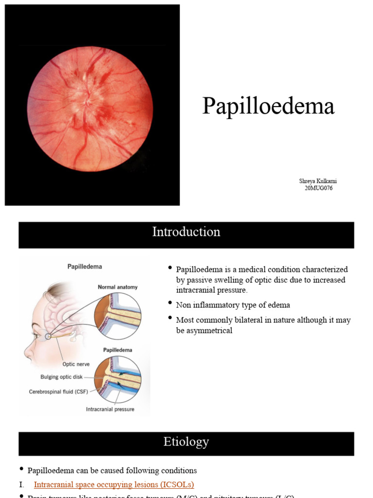 Papilloedema: Shreya Kulkarni 20MUG076 | PDF | Neurological Disorders | Clinical Medicine