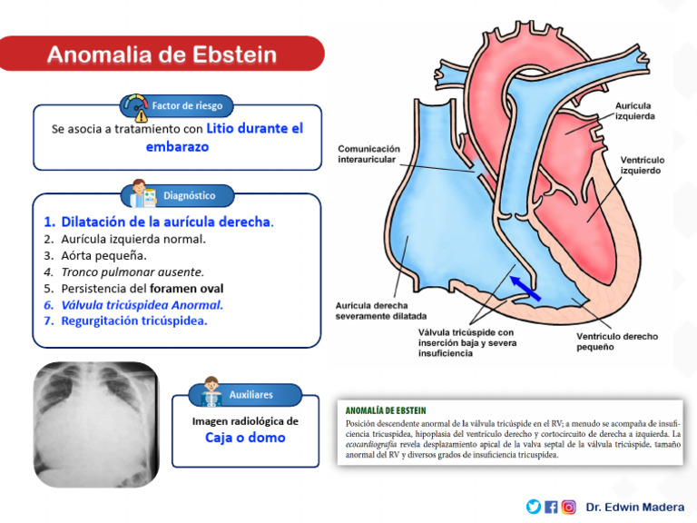Anomalía de Ebstein: Diagnóstico y Tratamiento | PDF