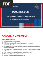 Escala ASPECTS | PDF