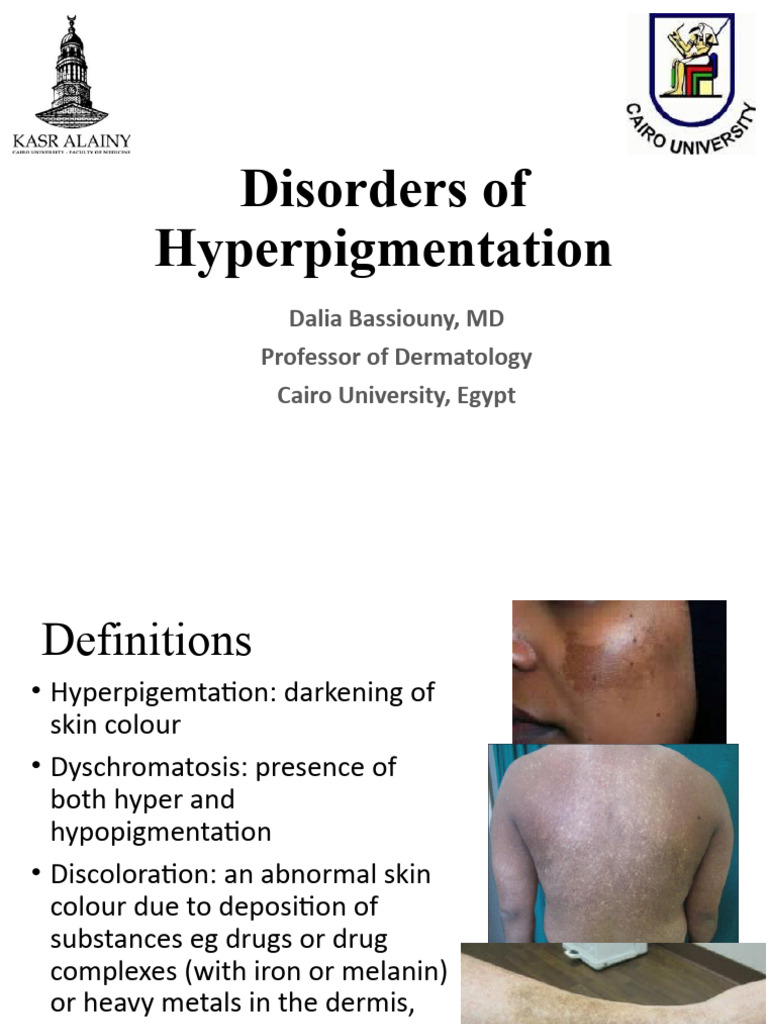 Disorders of Hyperpigmentation Handout | PDF | Sunscreen | Ultraviolet