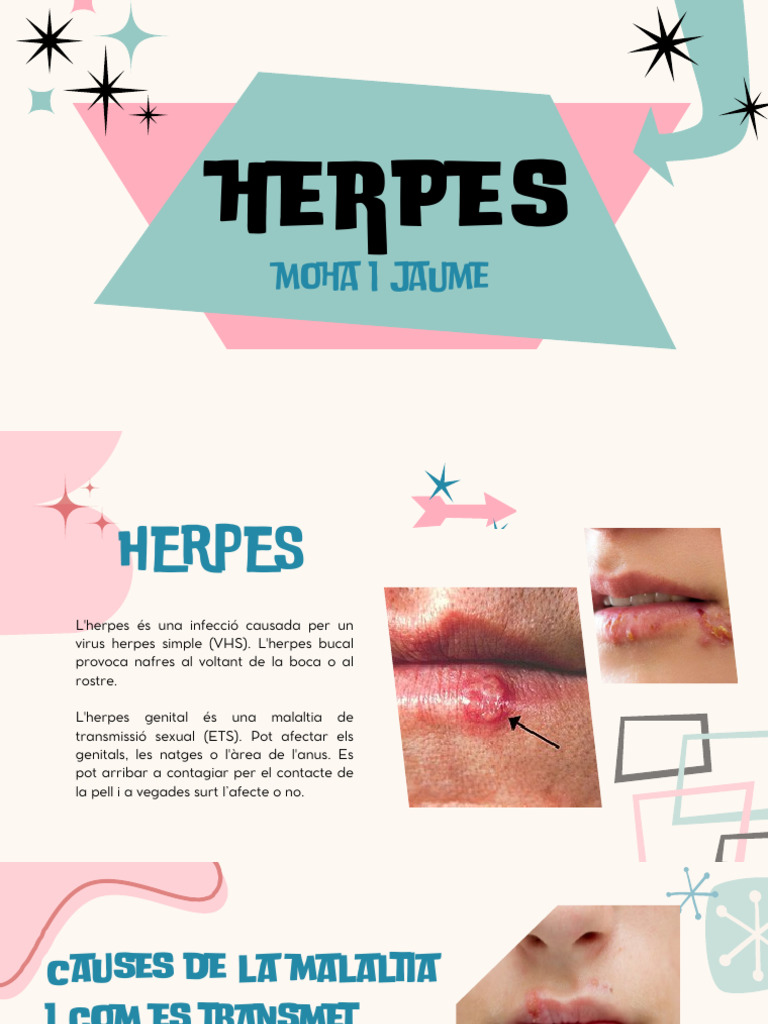 Herpes | PDF