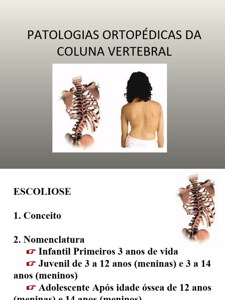 Escoliose-Hipercifose-Hiperlordose II | PDF | Escoliose | Coluna vertebral