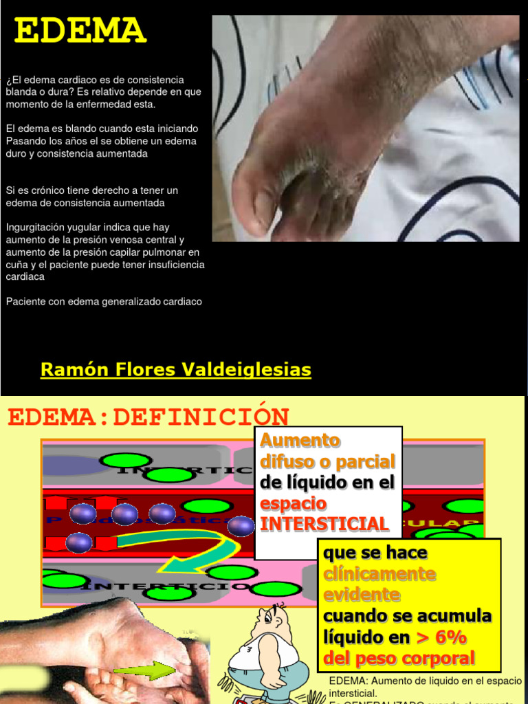 Edema: Tipos, Causas y Diagnóstico | PDF | Edema | Insuficiencia cardíaca
