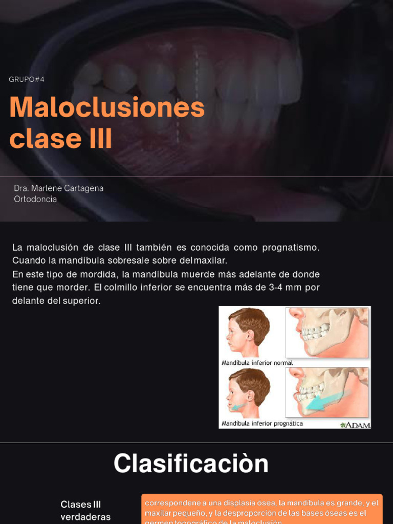 Maloclusion Clase III | PDF