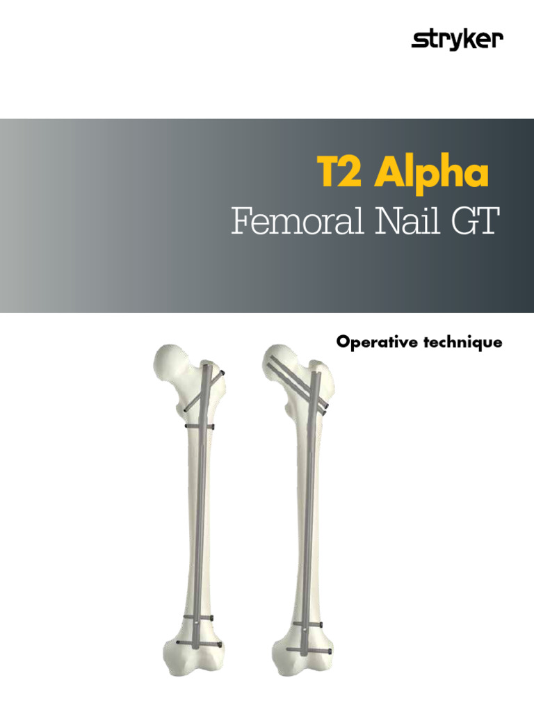 t2-st-25 Rev-1 t2 Alpha Femur-Antegrade GT Nailing System | PDF | Magnetic Resonance Imaging ...