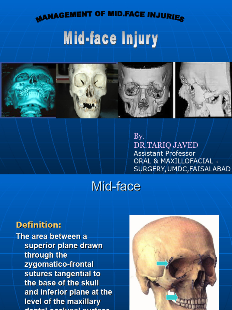 Mid-Face Injury | PDF | Human Nose | Skeletal System