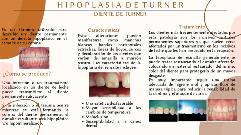 Diente de Turner | PDF