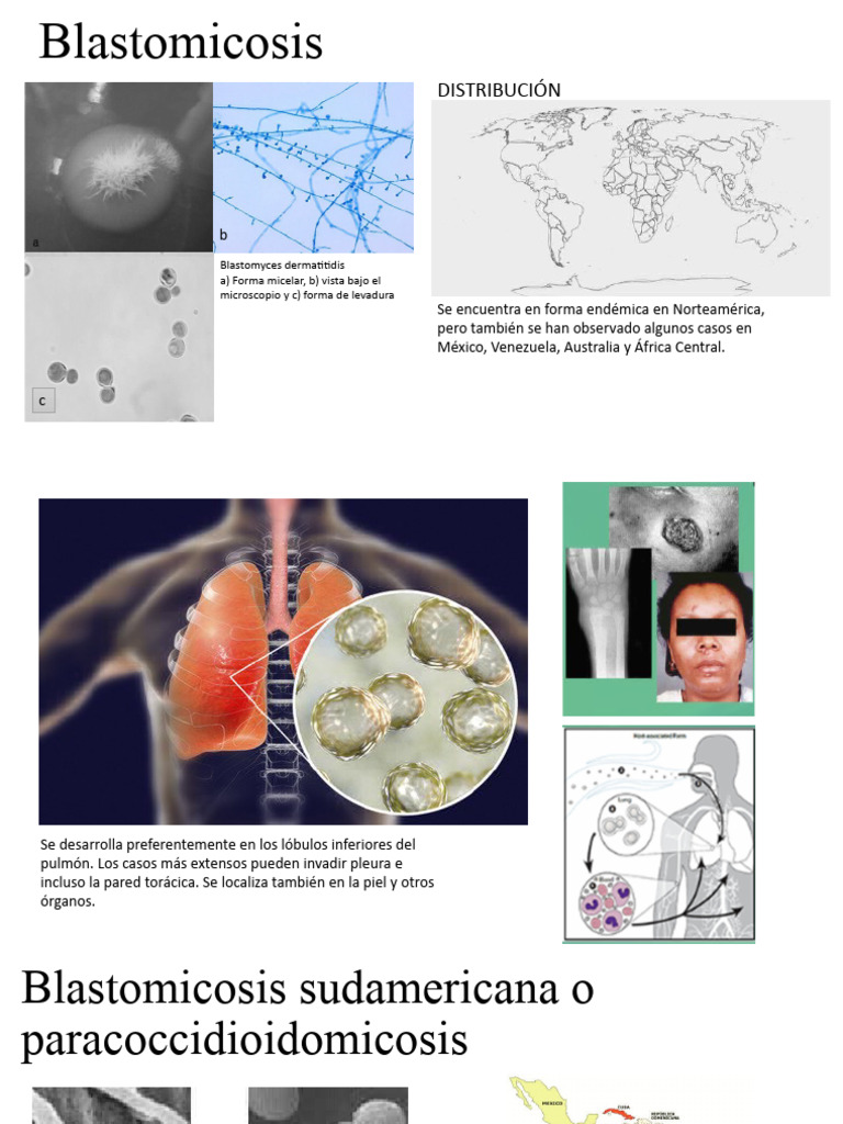 BLASTOMICOSIS | PDF | Inmunología | Microbiología