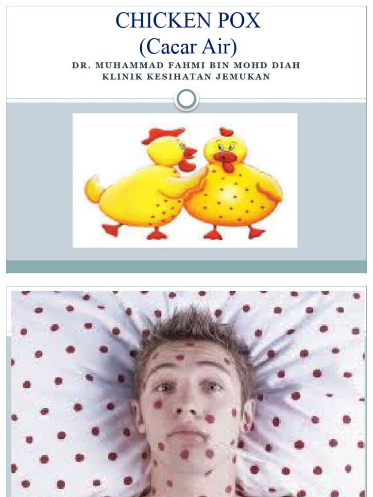 Simptom dan Rawatan Chicken Pox Dewasa | PDF