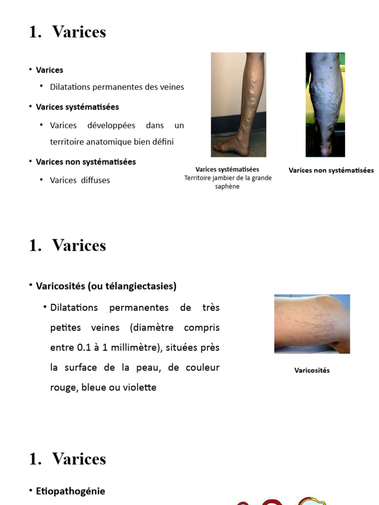 5 Semiologie Chirurgicale Vasculaire Varices | PDF | Varices | Causes ...