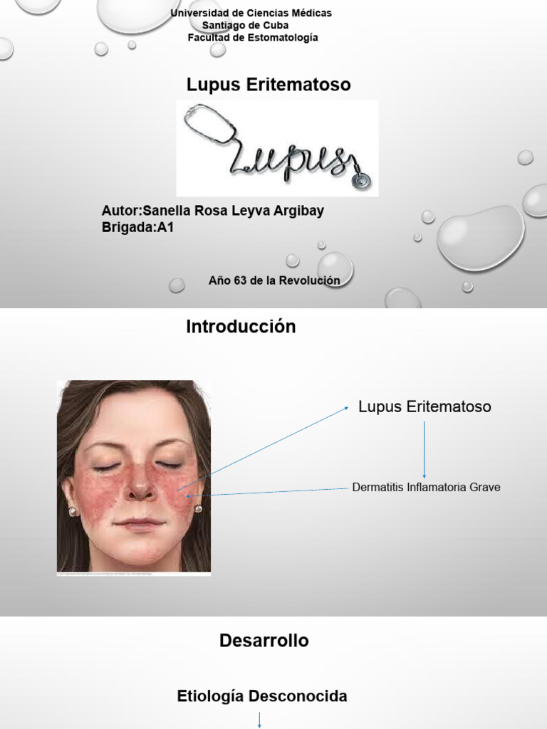 Lupus | PDF | Medicina CLINICA | Especialidades Medicas