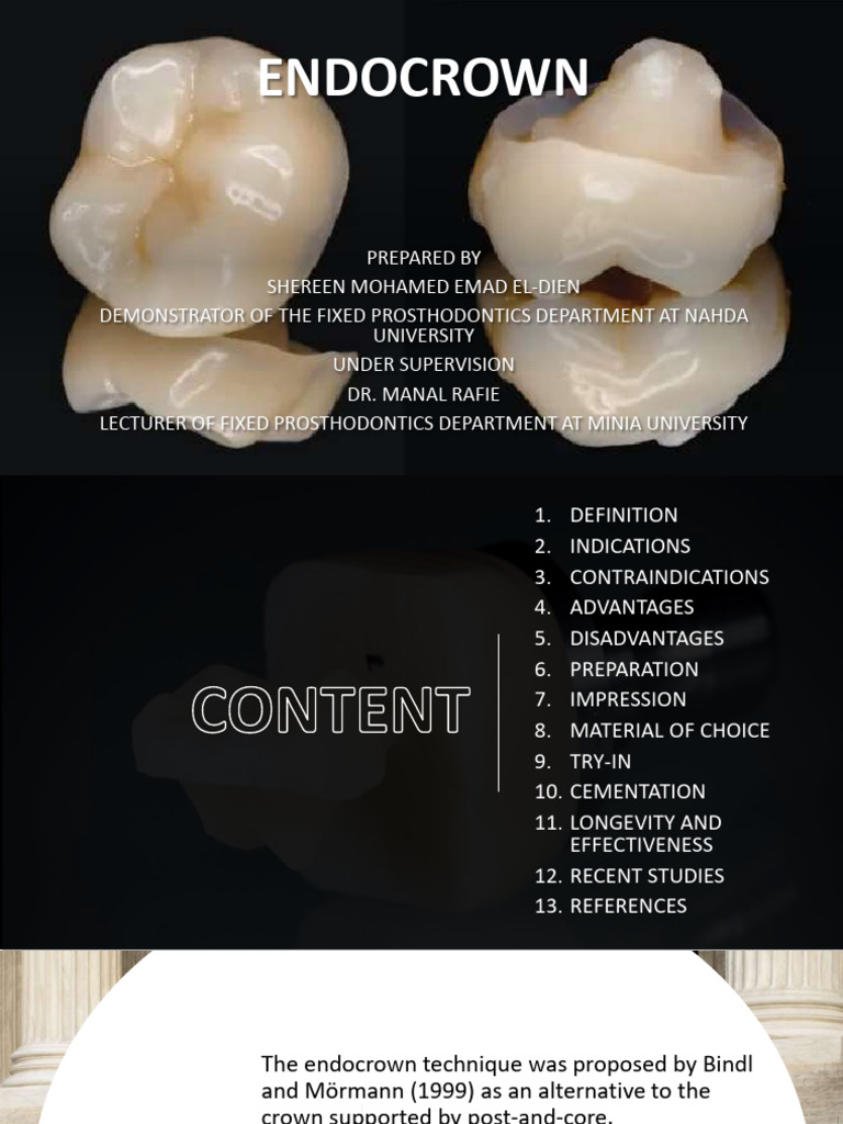 Endocrowns - Shereen | PDF | Materials | Dentistry Branches