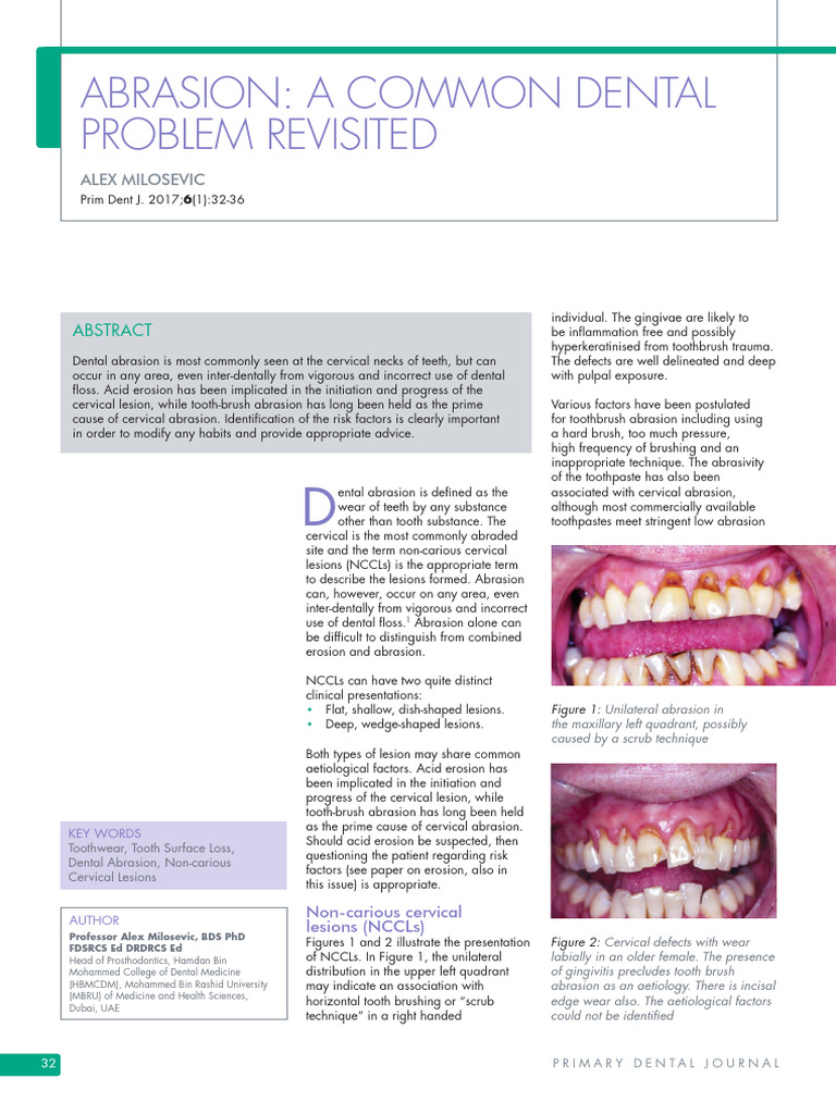 Understanding Dental Abrasion Causes | PDF | Medical Specialties ...