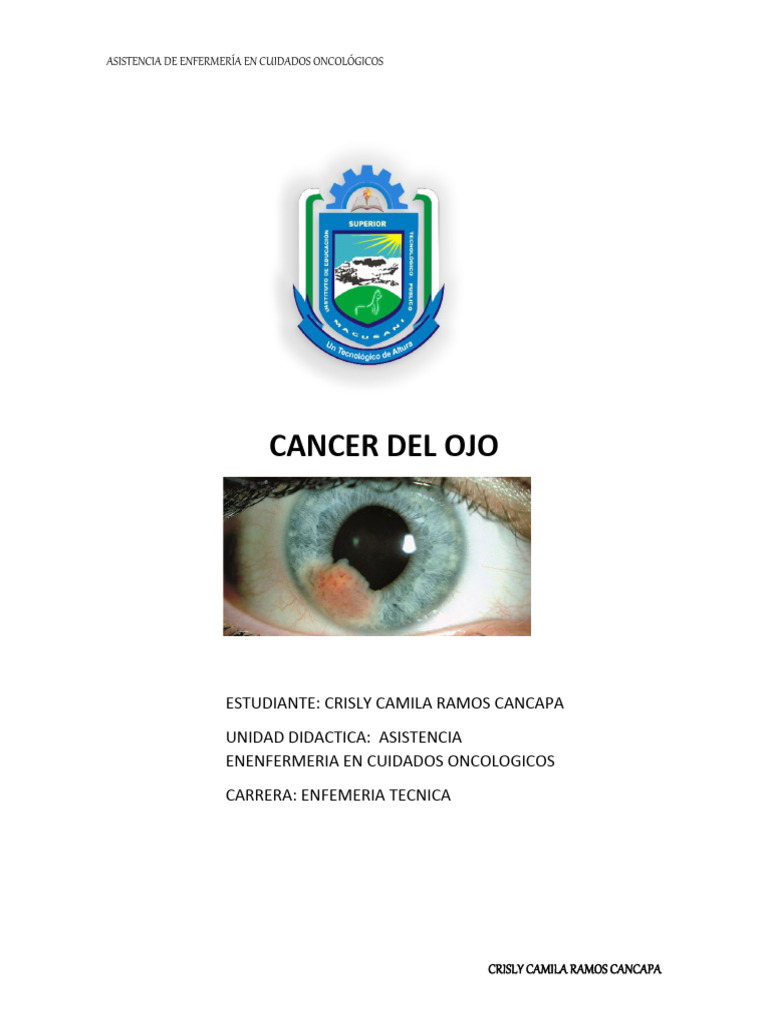 Cancer Del Ojo | PDF | Ojo humano | Cáncer