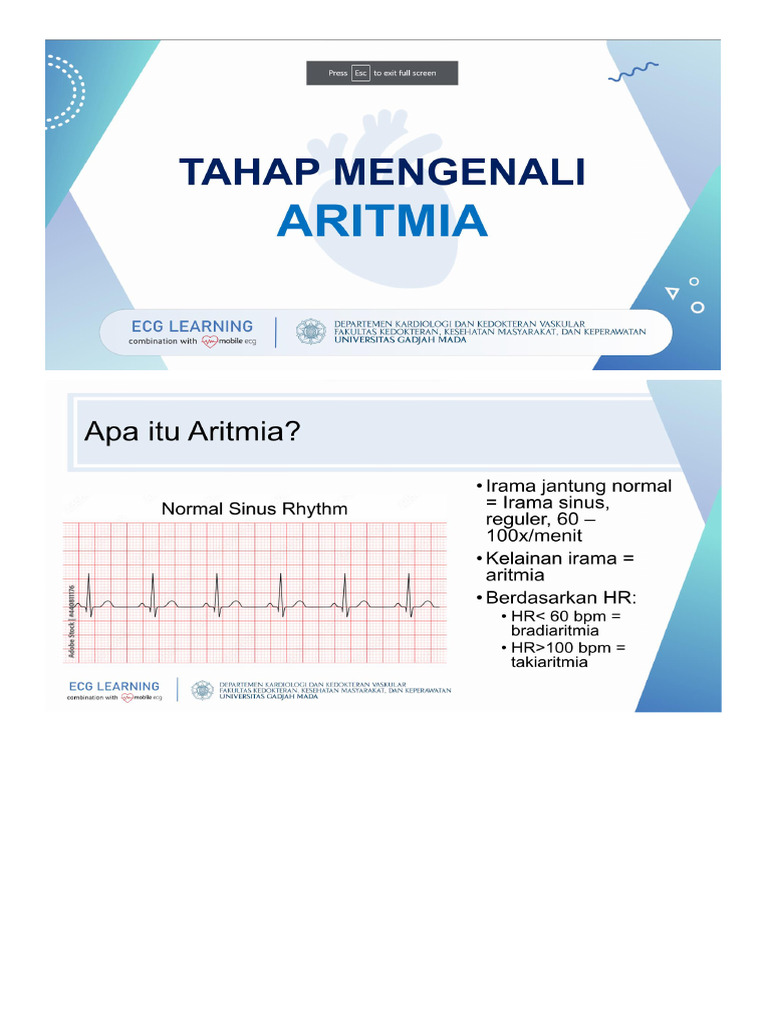 Tahap Mengenali Aritmia | PDF