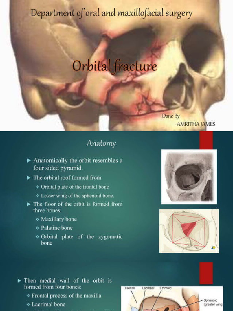 Orbital Fracture | PDF