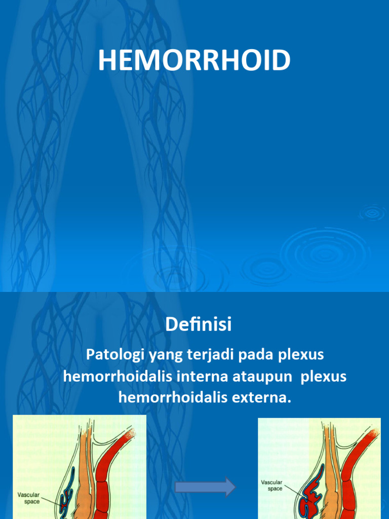 Hemorhoids Presentation | PDF