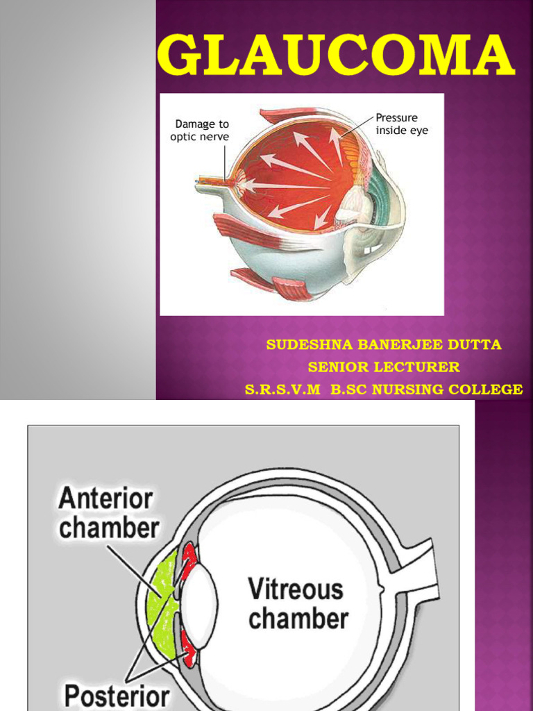 Understanding Glaucoma Types and Management | PDF | Glaucoma | Visual System