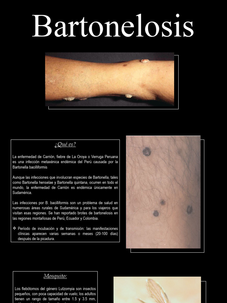 Bartonelosis Exposición 3 Unidad | PDF | Enfermedades y trastornos ...