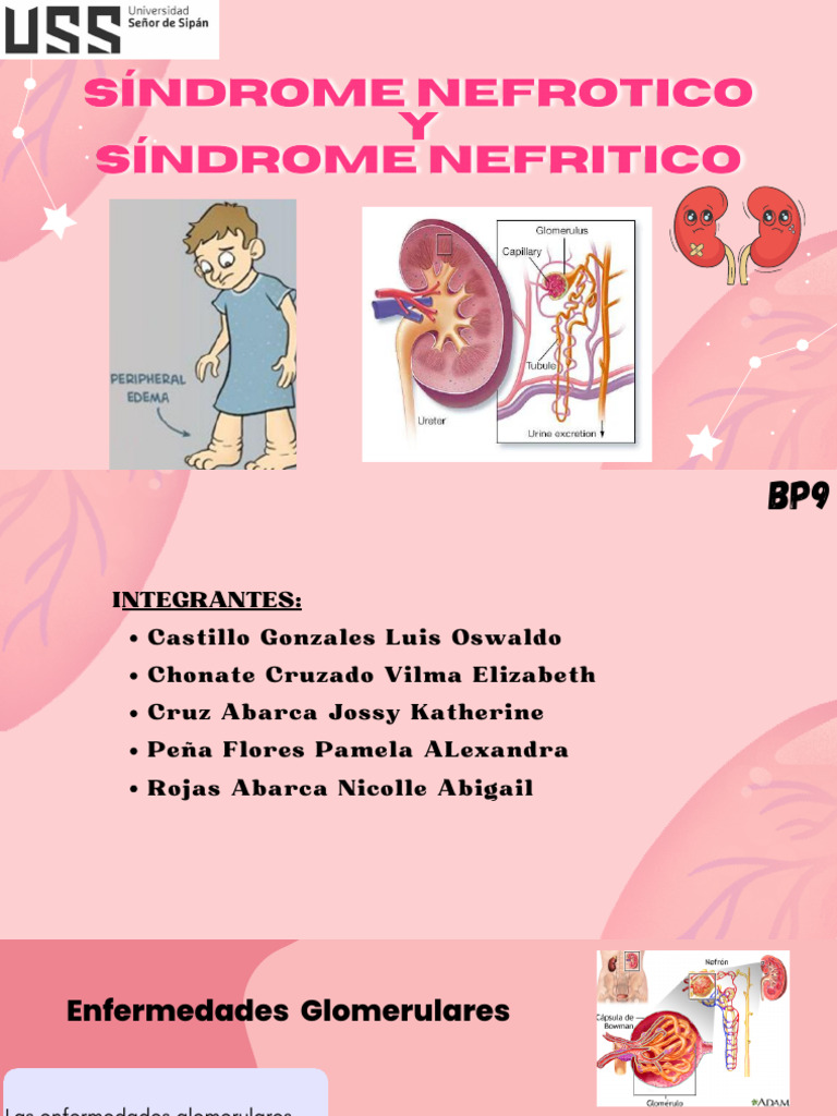 Sindrome Nefrotico y Nefritico | Descargar gratis PDF | Edema | Nefrología