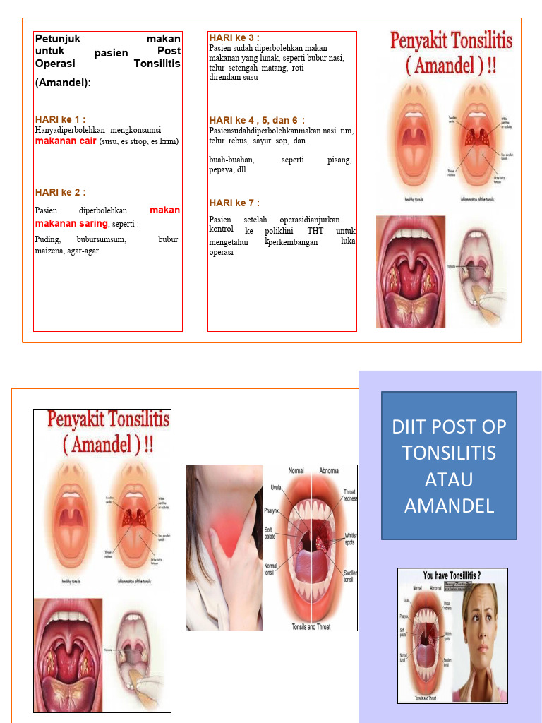 Post OP Tonsilitis | PDF