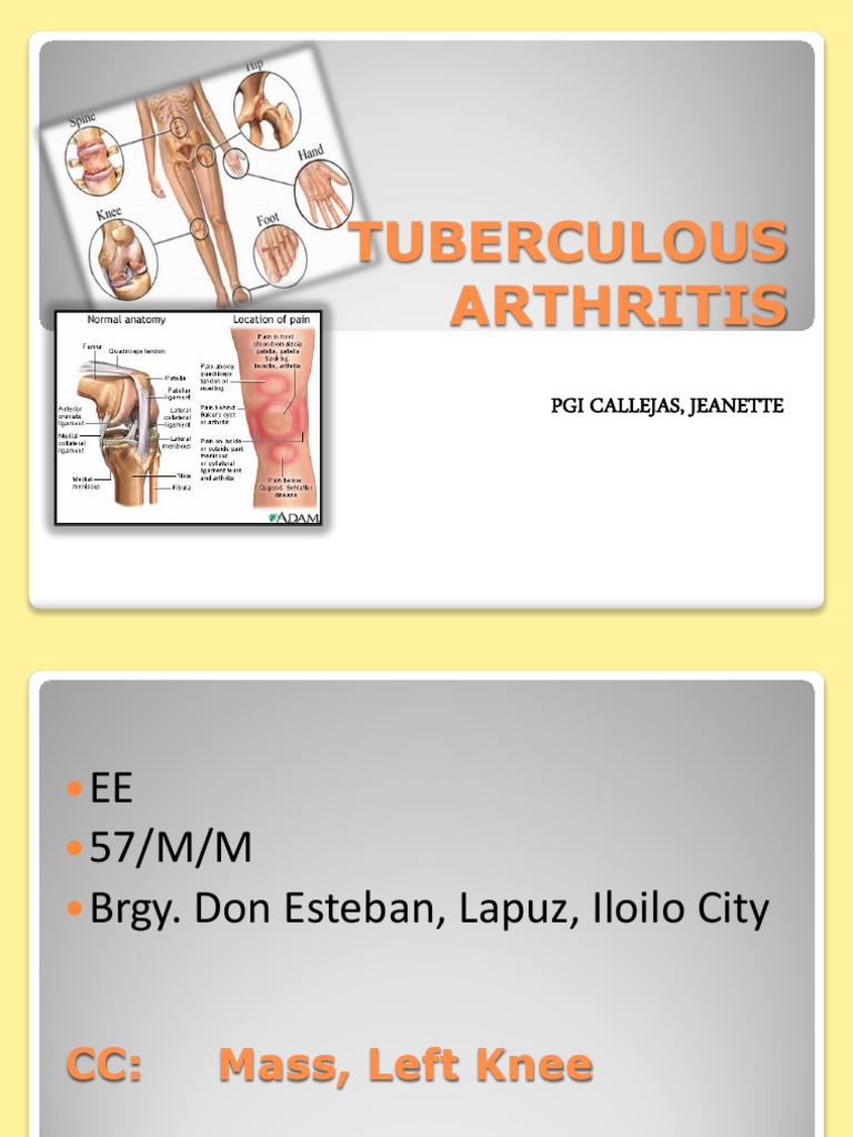 Tuberculous Arthritis | PDF | Joint | Arthritis