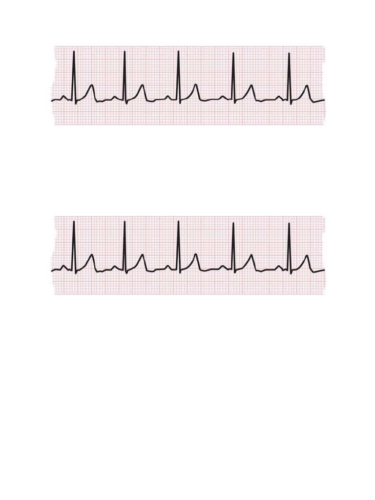 Ekg Normal | PDF