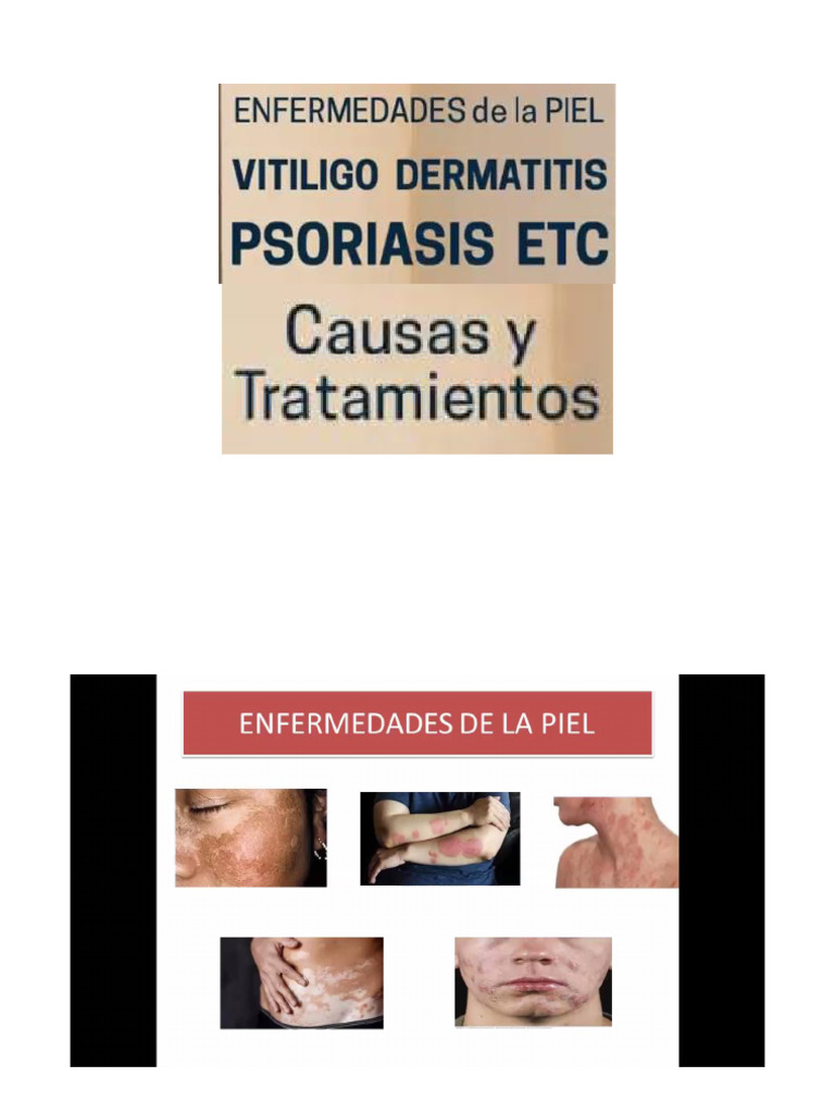 Psoriasis Dermatitis Vitiligio - DR Chabolla | PDF